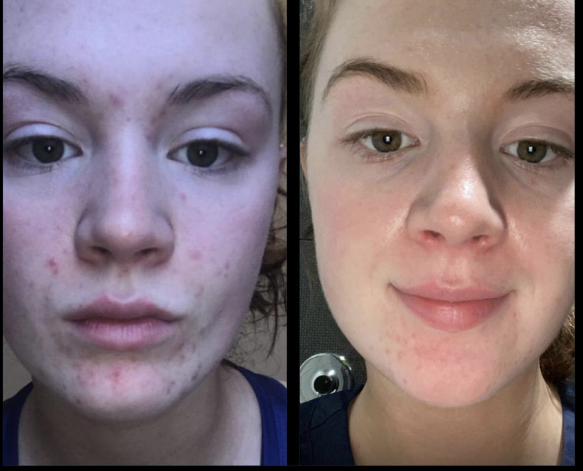 Plason Facial Services | Active Acne | Skin Regeneration | Collagen ...