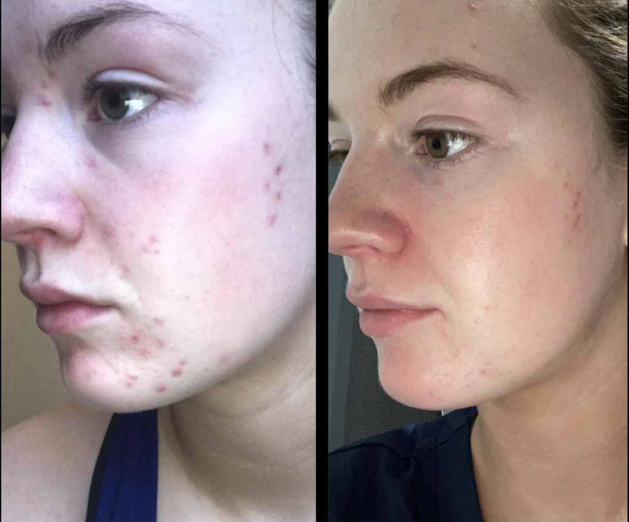 Plason Facial Services | Active Acne | Skin Regeneration | Collagen ...