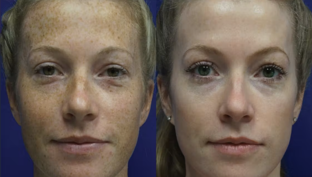 IPL (Intense Pulsed Light) | Encinitas | Carlsbad, CA | REJUV