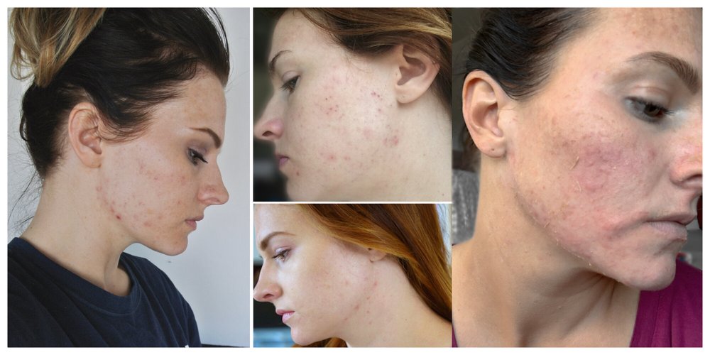 FIVE WAYS TO BUST ACNE WHILE YOU'RE ON LOCK DOWN — THE BEAUTY SNOOP