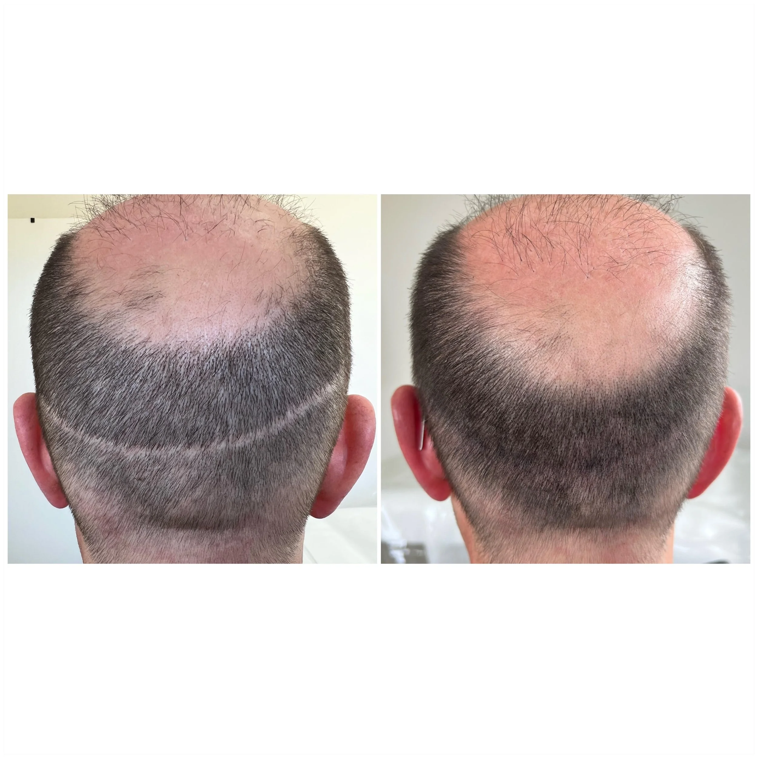Scalp Micropigmentation — I.D ARTSY
