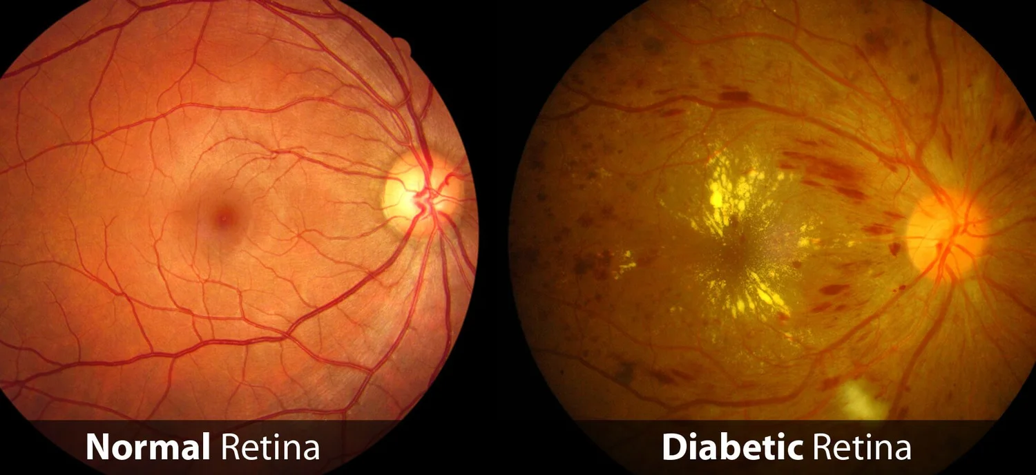 DIABETIC EYE DISEASE — Spectacle Optometry