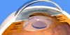 CATARACT AWARENESS — Spectacle Optometry