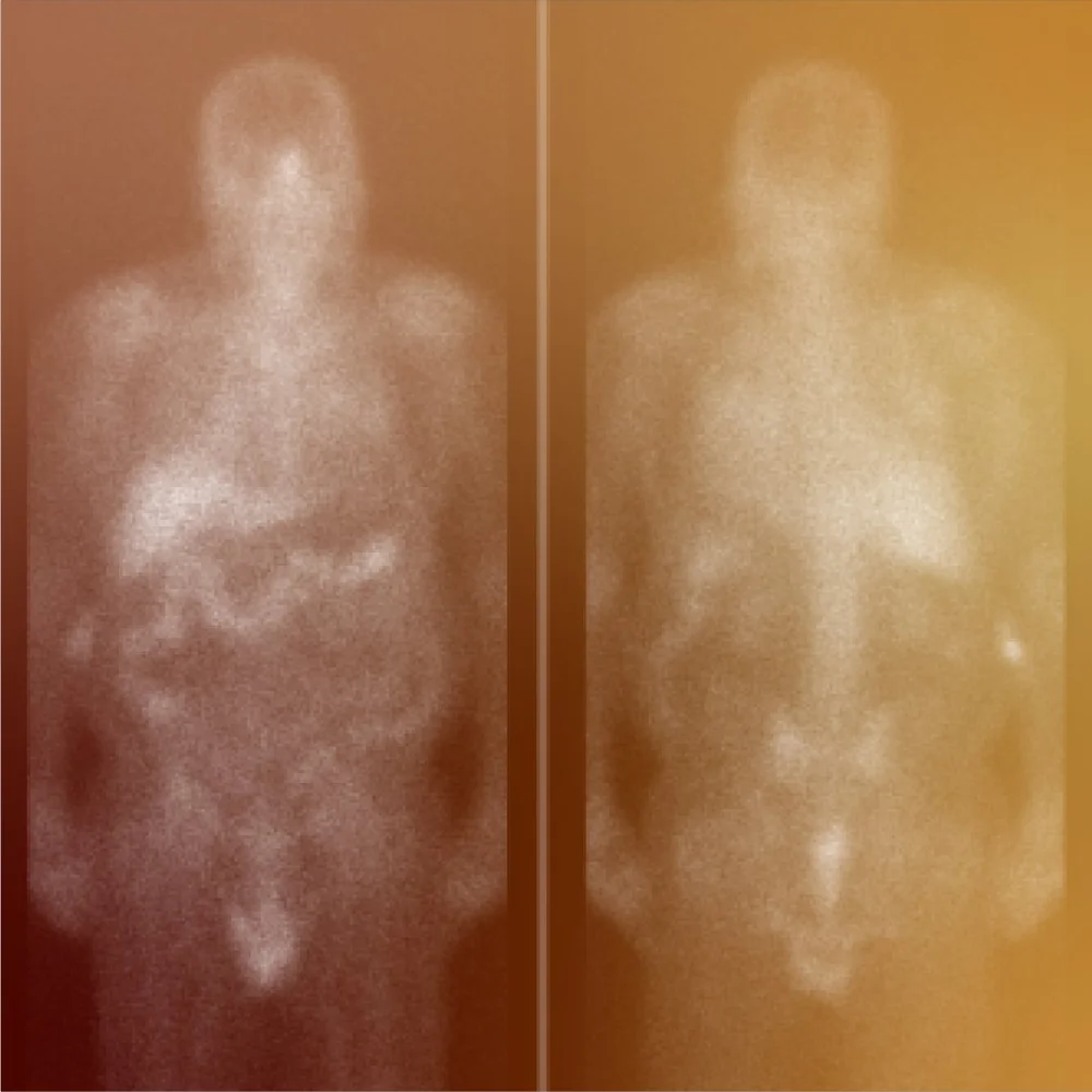 Diagnosis And Corresponding Gallium Scan