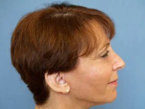 Face Procedures — Linda Huang, MD: Top Denver Plastic Surgeon