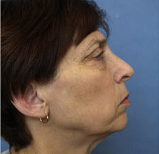 Face Procedures — Linda Huang, MD: Top Denver Plastic Surgeon