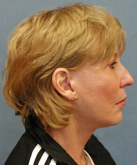 Face Procedures — Linda Huang, MD: Top Denver Plastic Surgeon