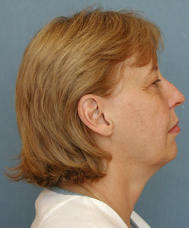 Face Procedures — Linda Huang, MD: Top Denver Plastic Surgeon