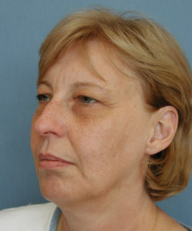 Face Procedures — Linda Huang, MD: Top Denver Plastic Surgeon