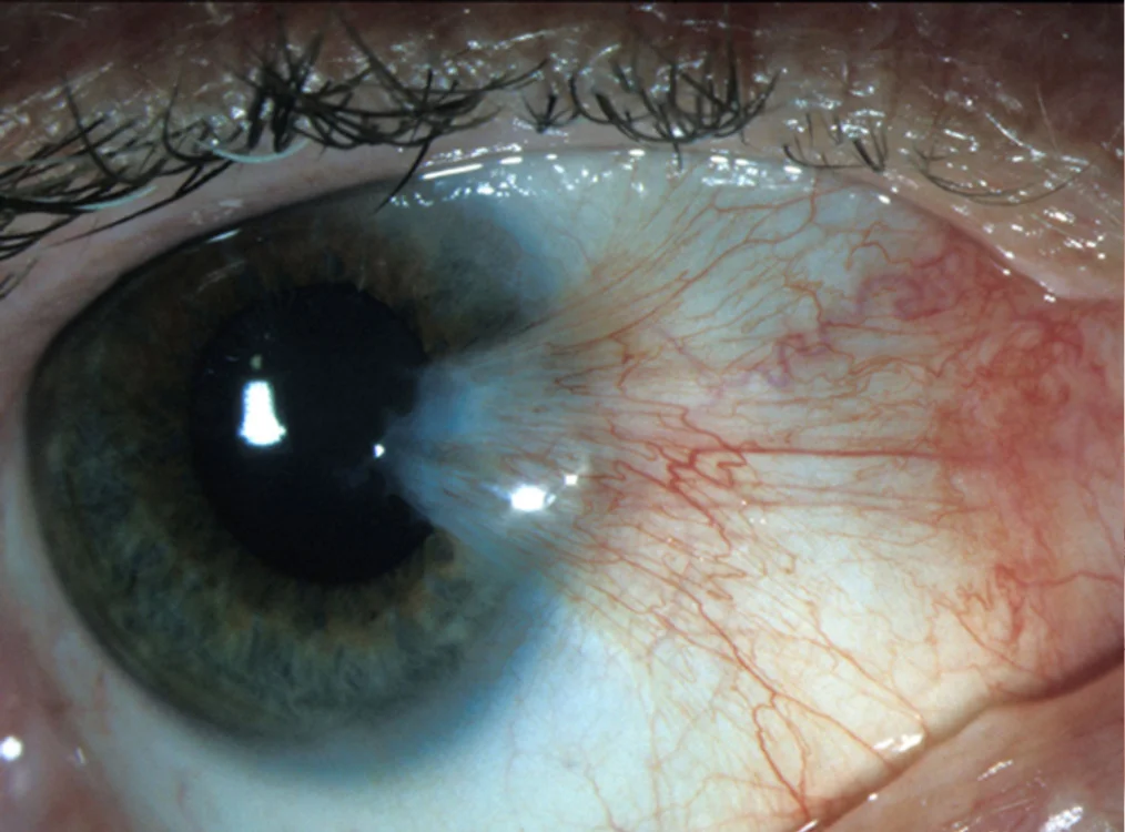 Pterygiums Surgery Brisbane Queensland — Brisbane Ophthalmologist | Dr ...