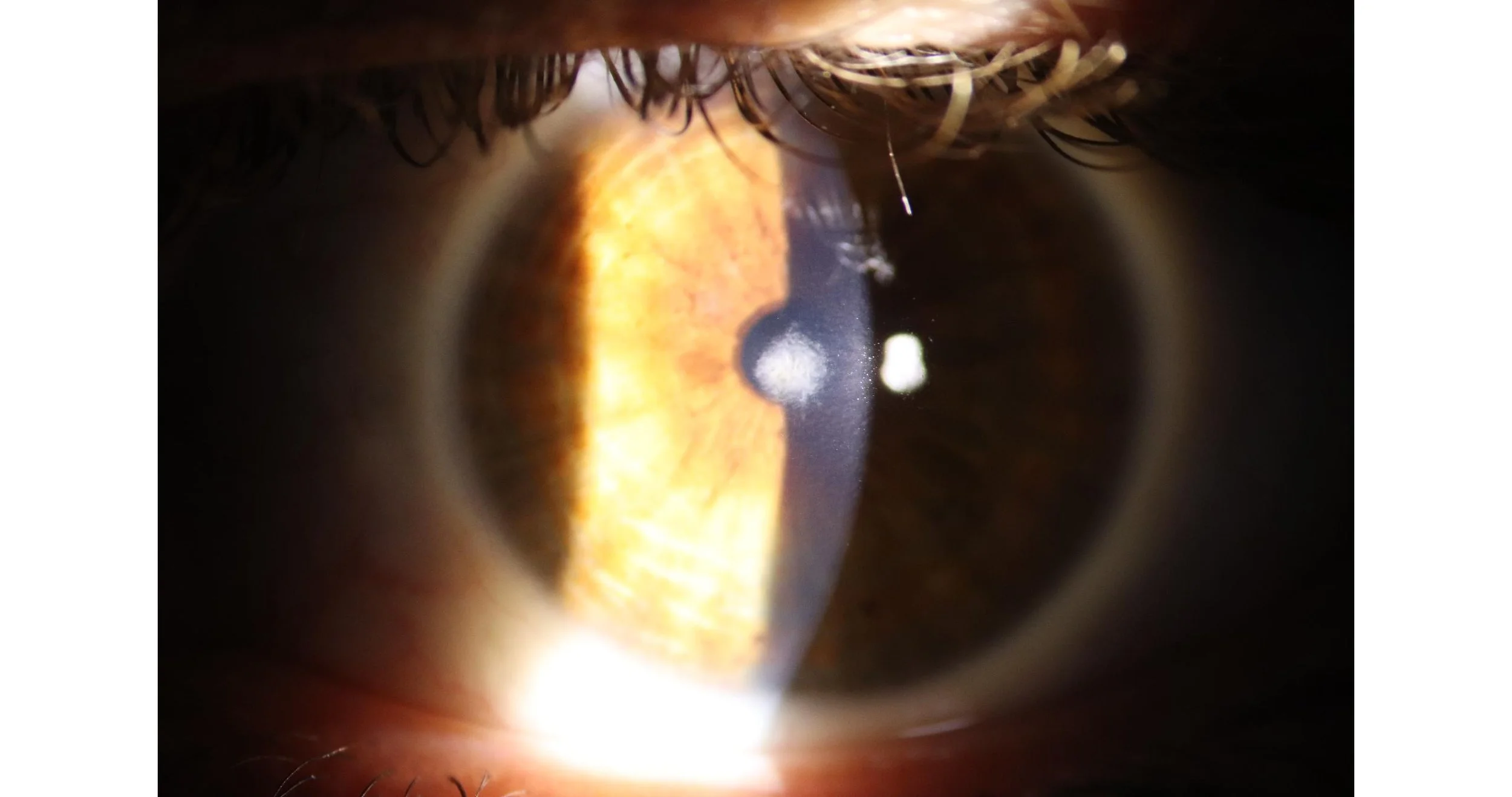 Ophthalmology News & Events — Brisbane Ophthalmologist | Dr Brendan Cronin