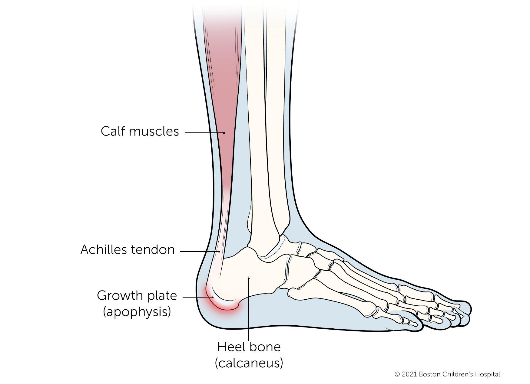 Heel Pain in kids - by Physiotherapist Malcolm Sanderson — ProActive ...