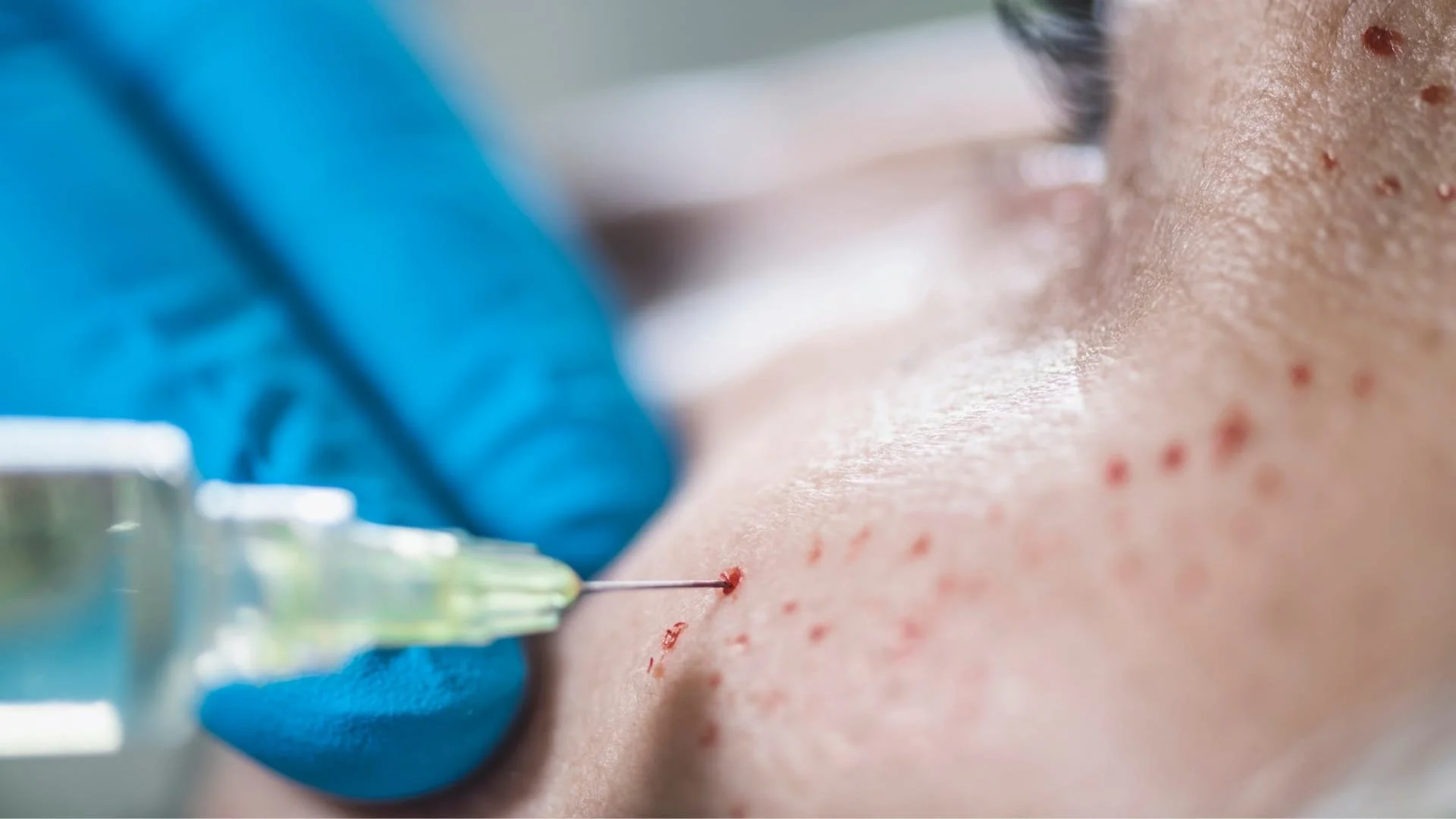 Exosomes vs PRP: Transform Your Skin Care Routine | Kim Gallo Esthetics