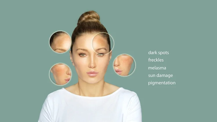 Hyperpigmentation in Skincare: Causes, Treatments, & Prevention | Kim ...
