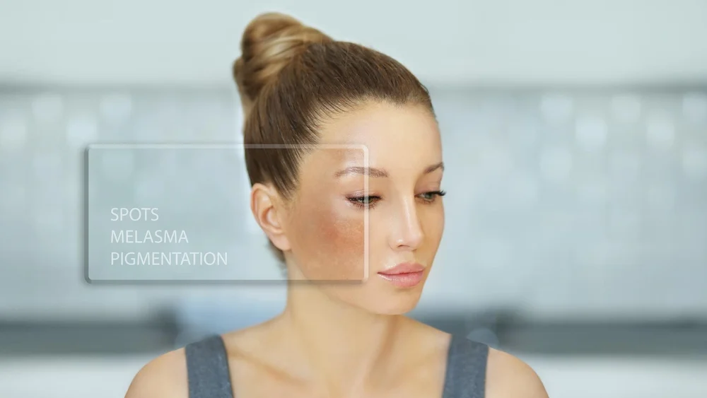 Ways to Treat Hyperpigmentation: What You Need to Know | Kim Gallo ...