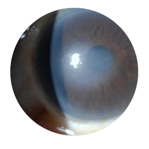 About Fuch's Dystrophy — Moyes Eye Center