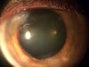 Salzmann's Nodular Degeneration — Moyes Eye Center