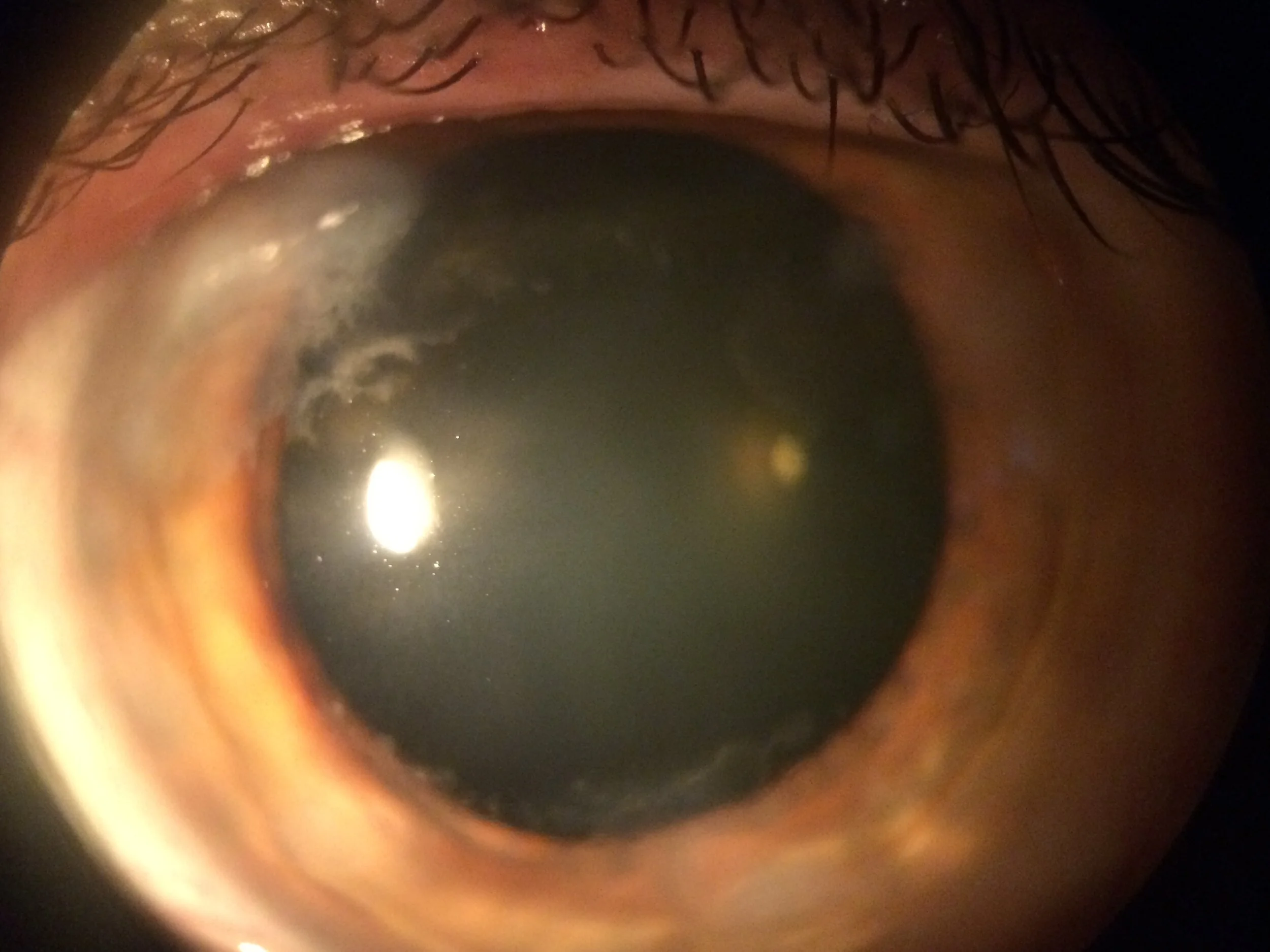 Salzmann's Nodular Degeneration — Moyes Eye Center