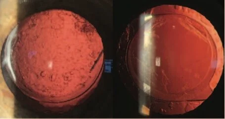 YAG Capsulotomy — Moyes Eye Center