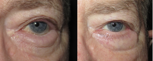 Entropion Repair — Moyes Eye Center
