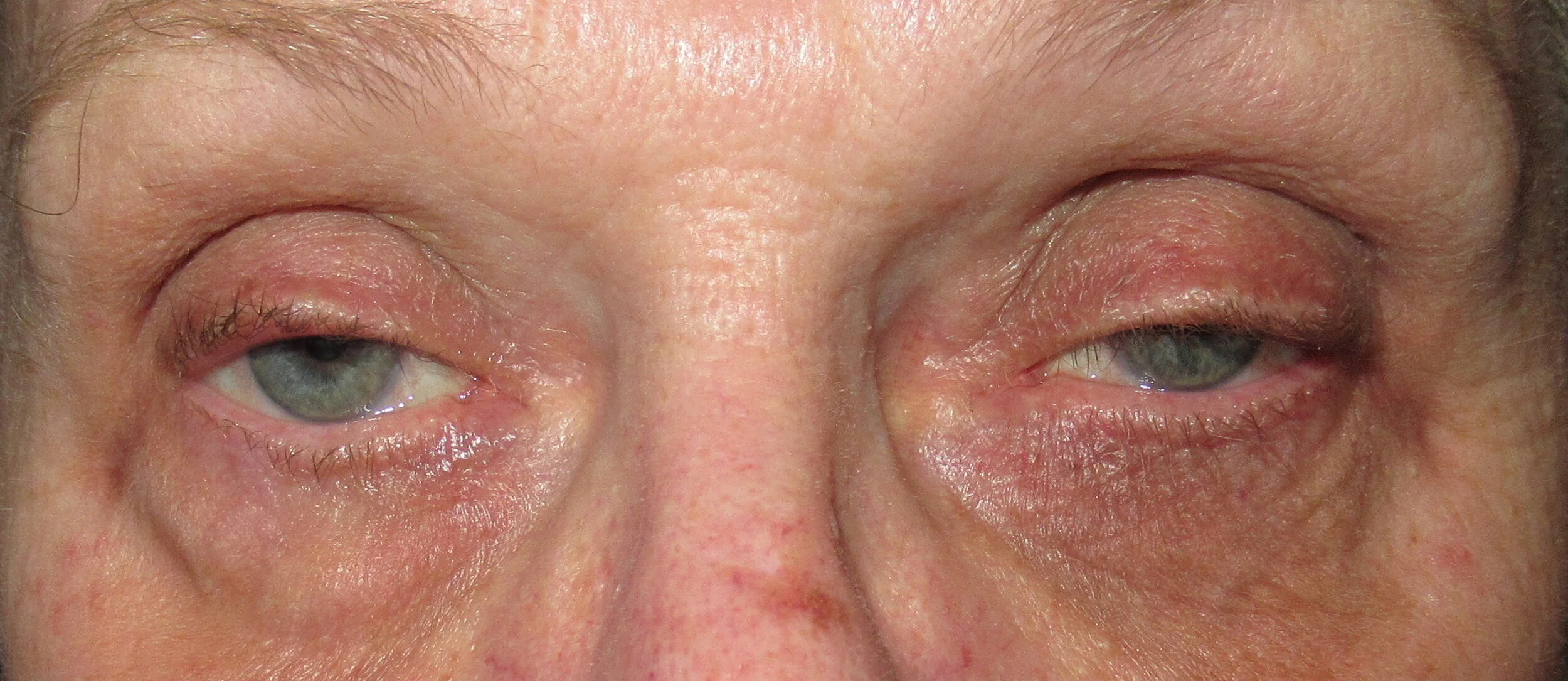 Ptosis Repair — Moyes Eye Center