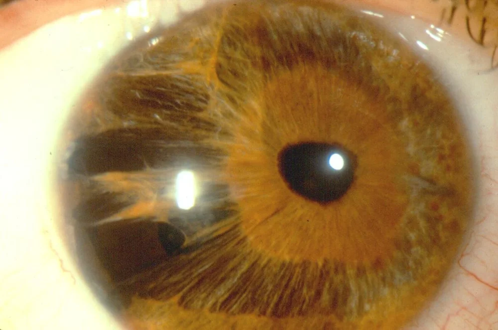 Chandlers Syndrome