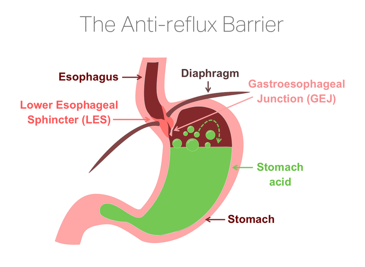 Underlying Causes of Acid Reflux - Testing and Natural Treatment