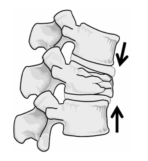 Bone Basics: Vertebral Fractures — Bone Talk
