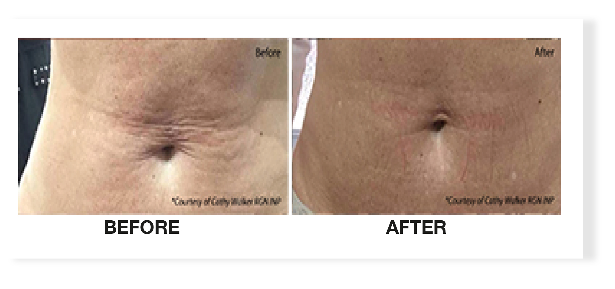 Profhilo injection treatment