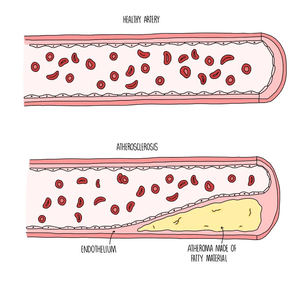 How Does A Fatty Streak Happen In Arteries