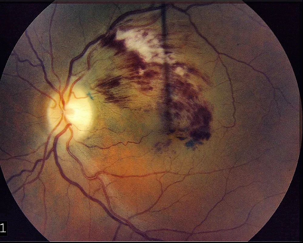 Branch Retinal Vein Occlusion Oct