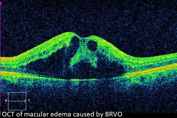 Ophthalmology Expert Witness Services