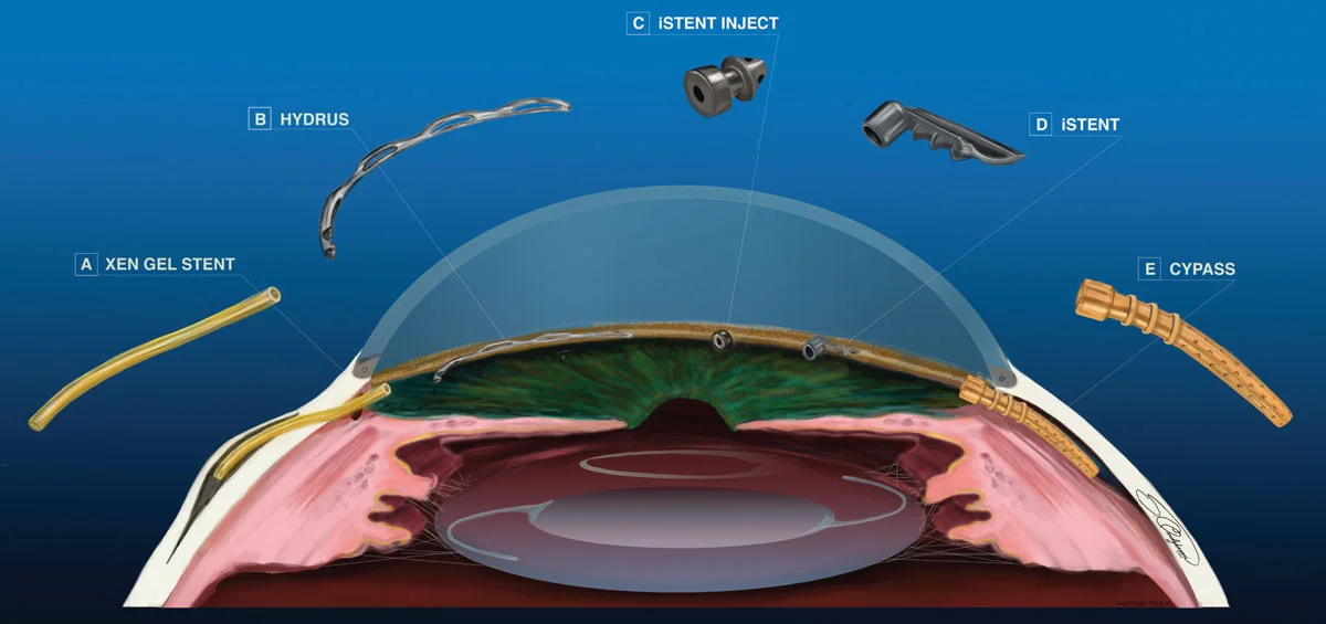Ophthalmology Expert Witness Services