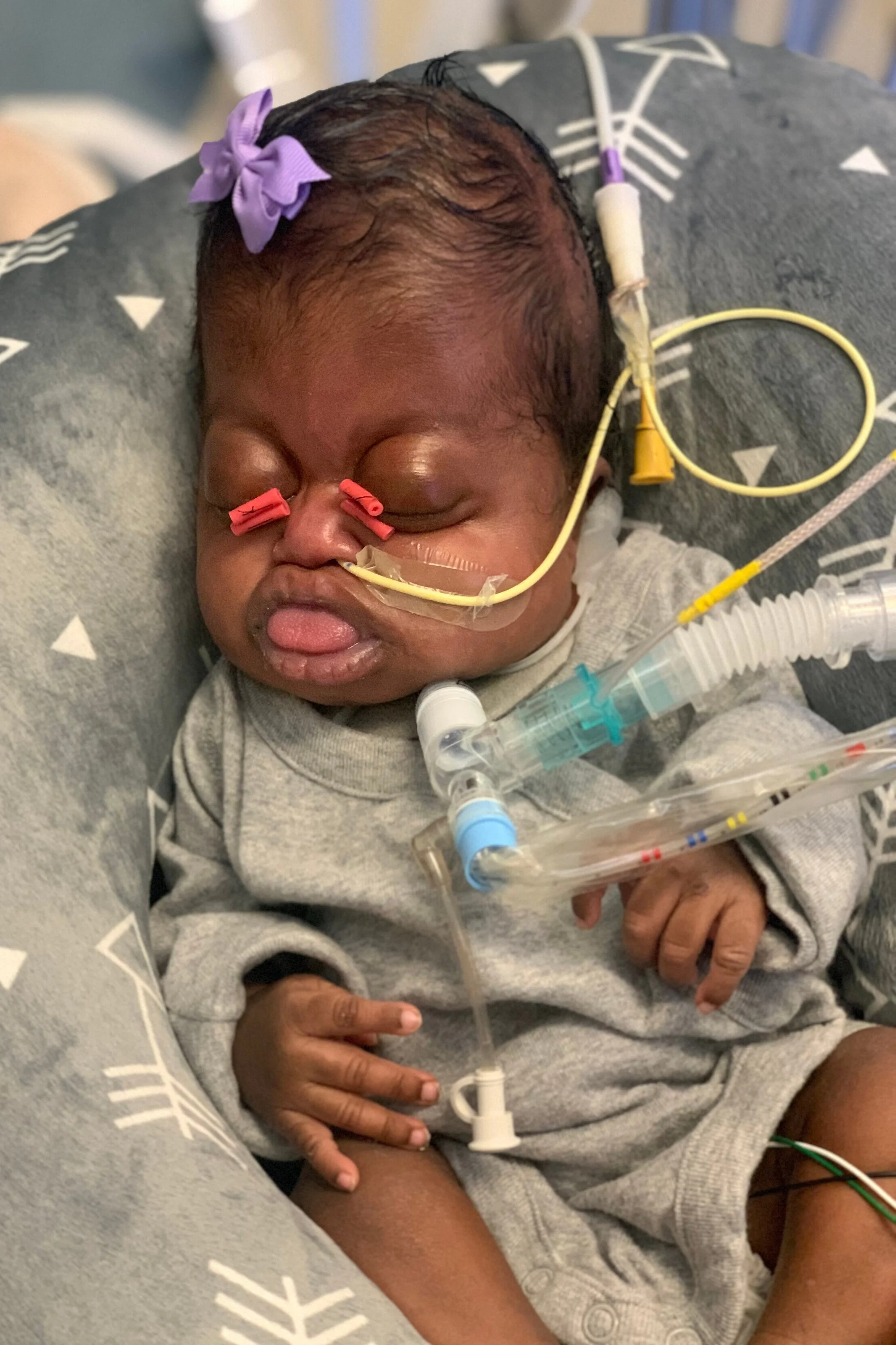 Pfeiffer Syndrome Part II- Treatment — FALESHA A. JOHNSON