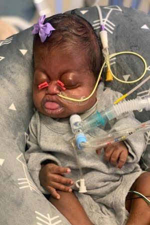 Pfeiffer Syndrome Part II- Treatment — FALESHA A. JOHNSON