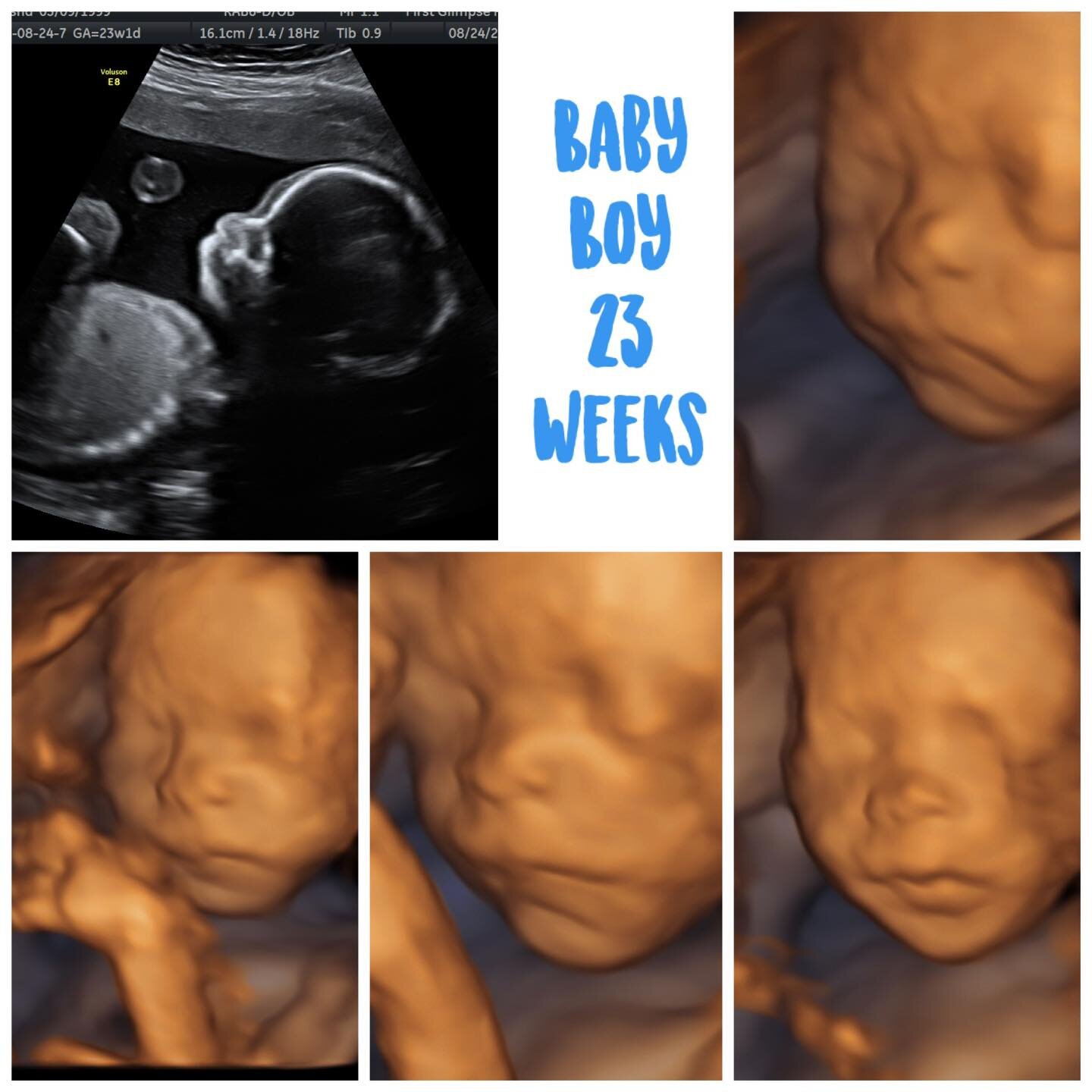 Sneak Peek — First Glimpse Prenatal Imaging