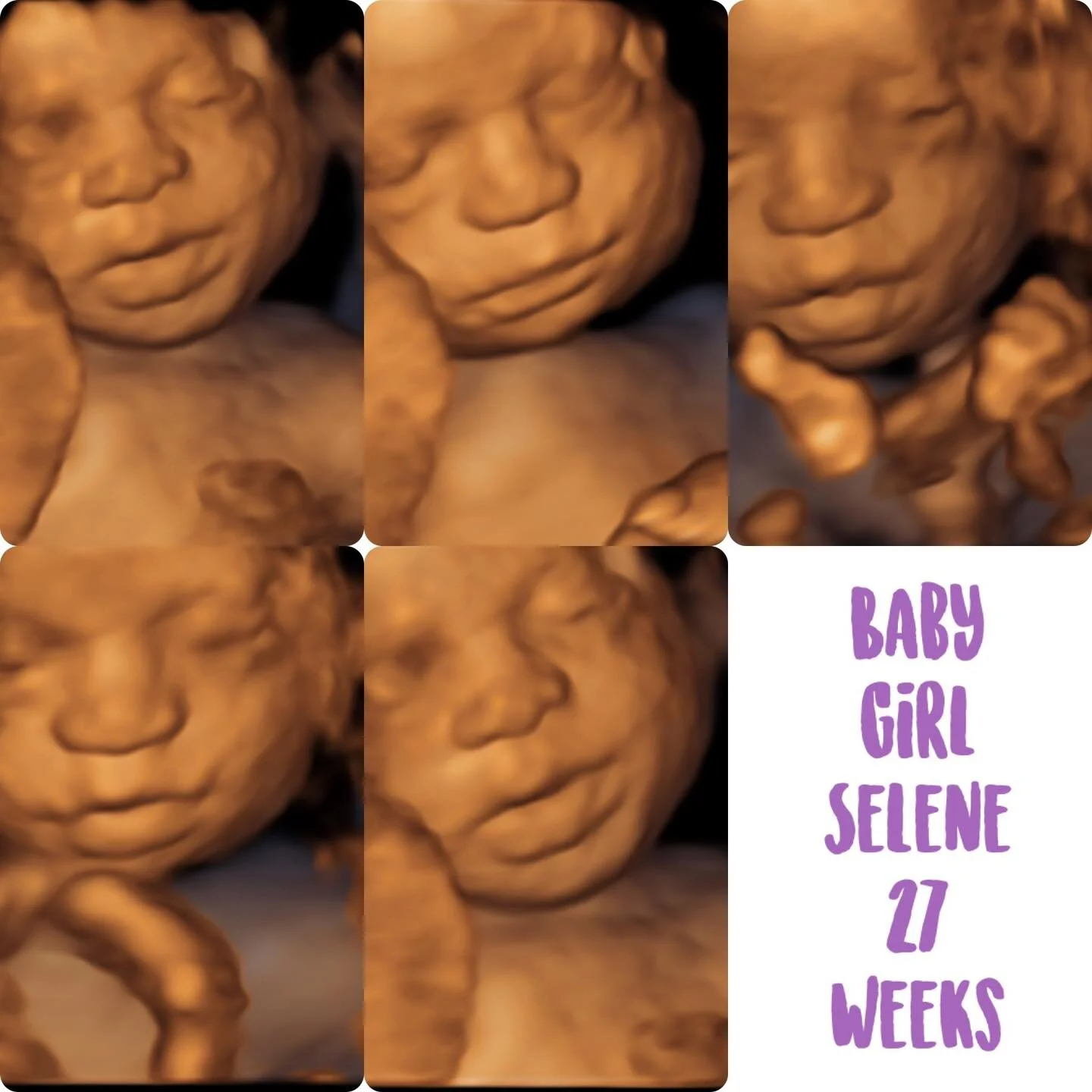 Sneak Peek — First Glimpse Prenatal Imaging