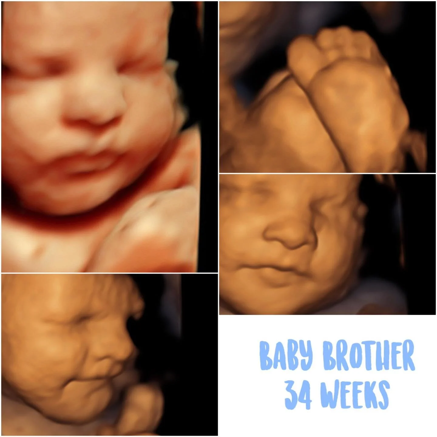 Sneak Peek Plus — First Glimpse Prenatal Imaging