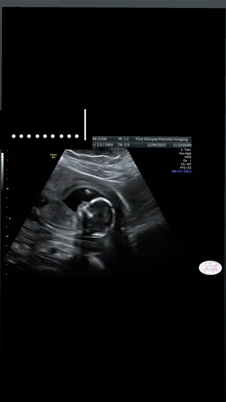 My Sweet Angel — First Glimpse Prenatal Imaging