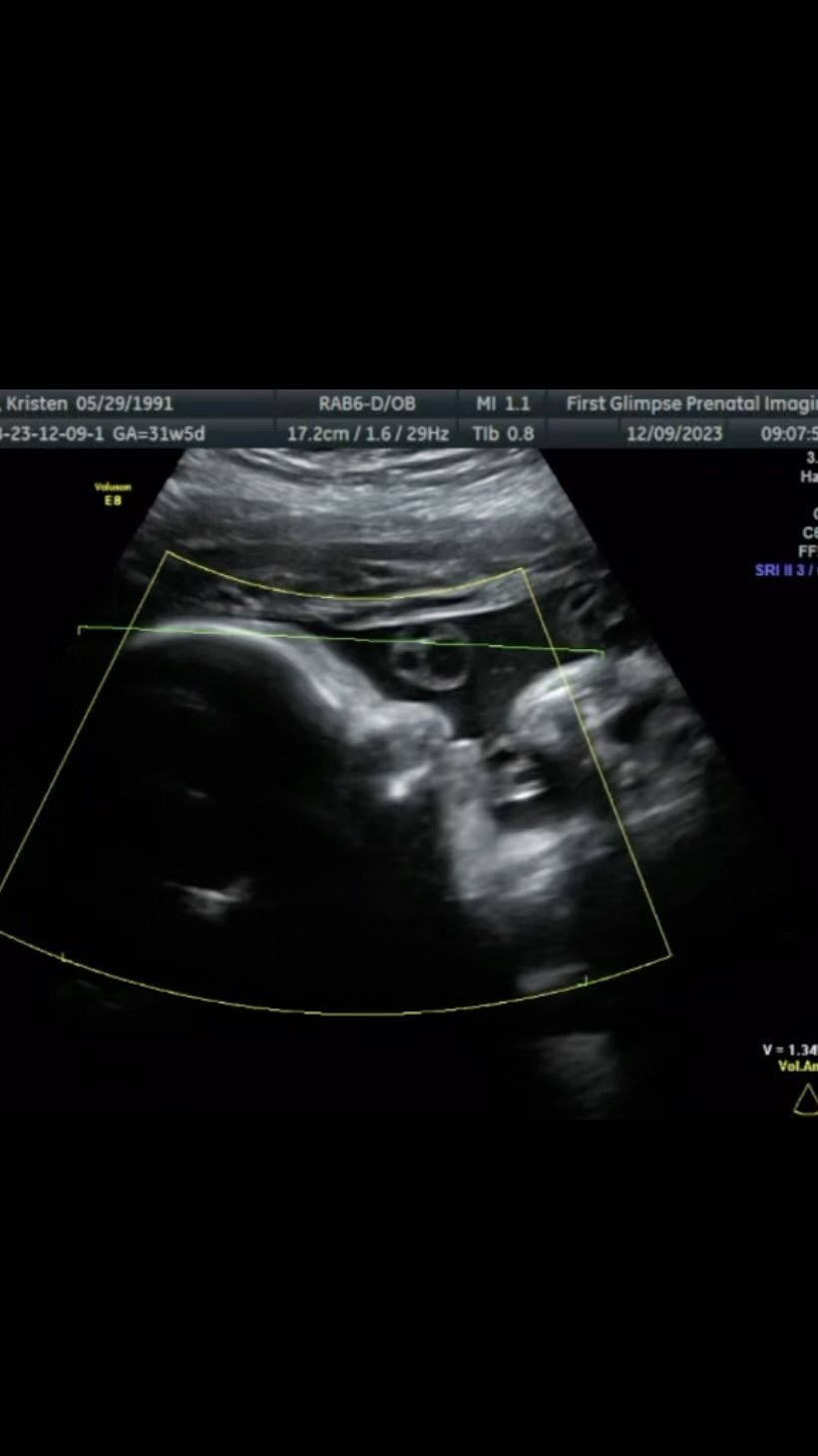 My Sweet Angel — First Glimpse Prenatal Imaging
