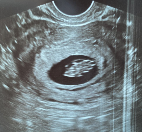 Early Pregnancy Ultrasounds — First Glimpse Prenatal Imaging