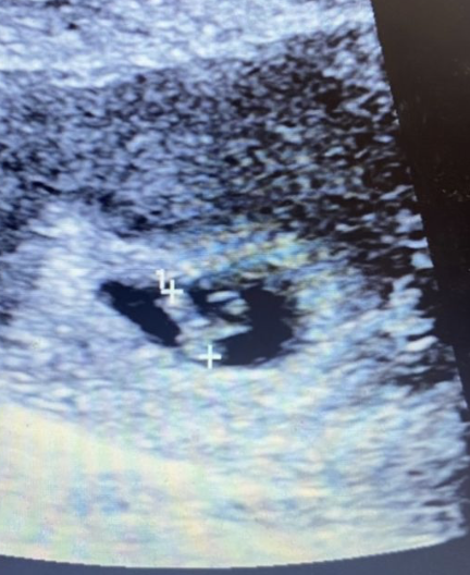 Early Pregnancy Ultrasounds — First Glimpse Prenatal Imaging