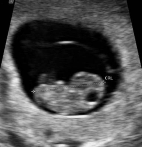 Early Pregnancy Ultrasounds — First Glimpse Prenatal Imaging