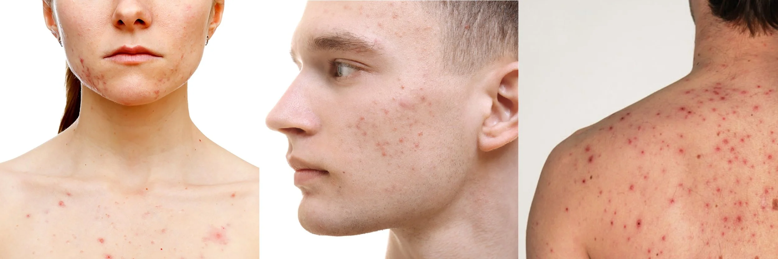Acne Treatments — In Depth Skin