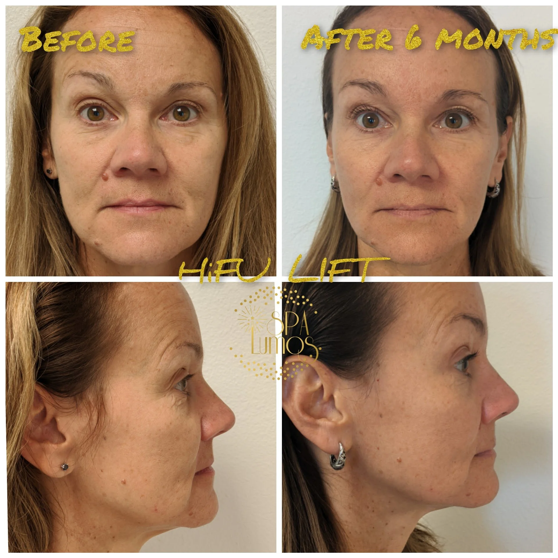 HiFU LIFT in Boise, ID | Spa Lumos — Spa Lumos