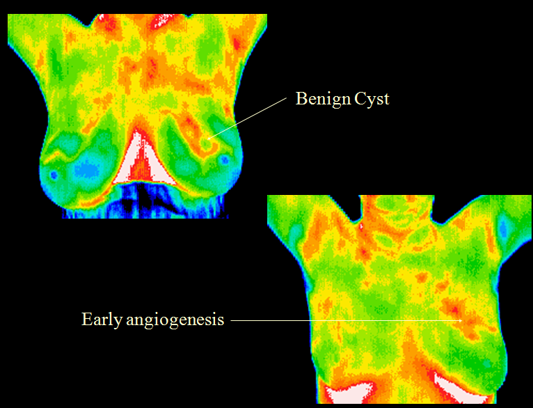 Thermography — Gratitude for Wellness