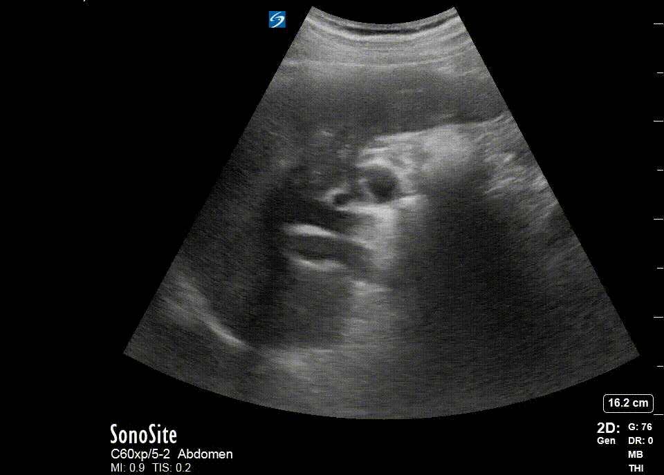 CBD Dilation | Mumin Hakim MD, Nicole Guerrero MD, Michael Halperin MD ...