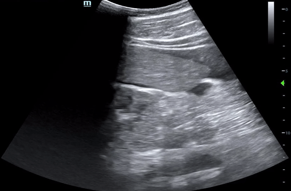 Traumatic Hemoperitoneum | Lucas Carleson MD | Boston, MA — Everyday ...