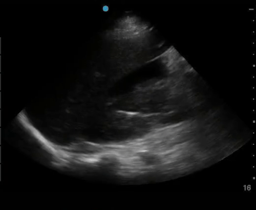 Ruptured Ectopic Pregnancy | Anirudh Ramachandran DO | Bronx, NY ...