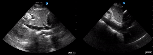 IVC versus Aorta — Everyday Ultrasound